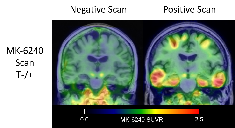 Research points to tau PET scans as the future of Alzheimer’s disease ...