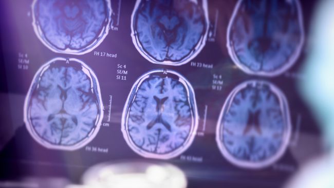 Dr. Nathaniel Chin discusses rising interest in Alzheimer's status on ...